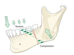 Intervento frattura della mandibola | Prof. Tartaro
